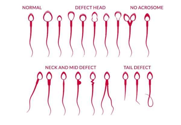 Semen Analysis Normal Report WHO Standards | View Reports